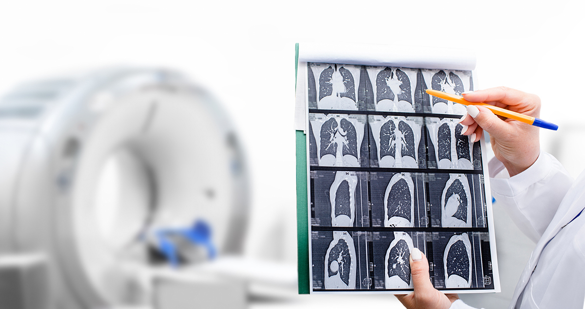 Lung cancer screening guidelines | McLaren Port Huron Blog